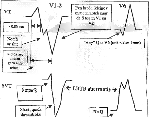 Brugada criteria